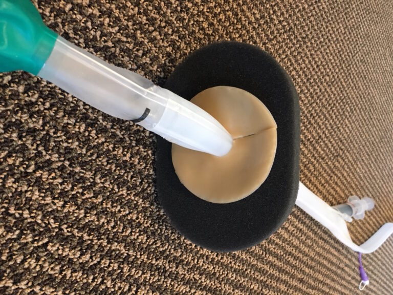 Protect Perineal Burns and Wounds without a Diverting Ostomy – Fistula ...