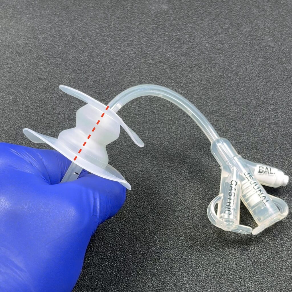 Stabilize PEG Tubes and Wound Drains to Reduce Insertion Site Leakage ...