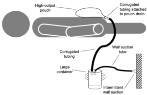 High-output Fistula and Ostomy Effluent Containment - Fistula Solution