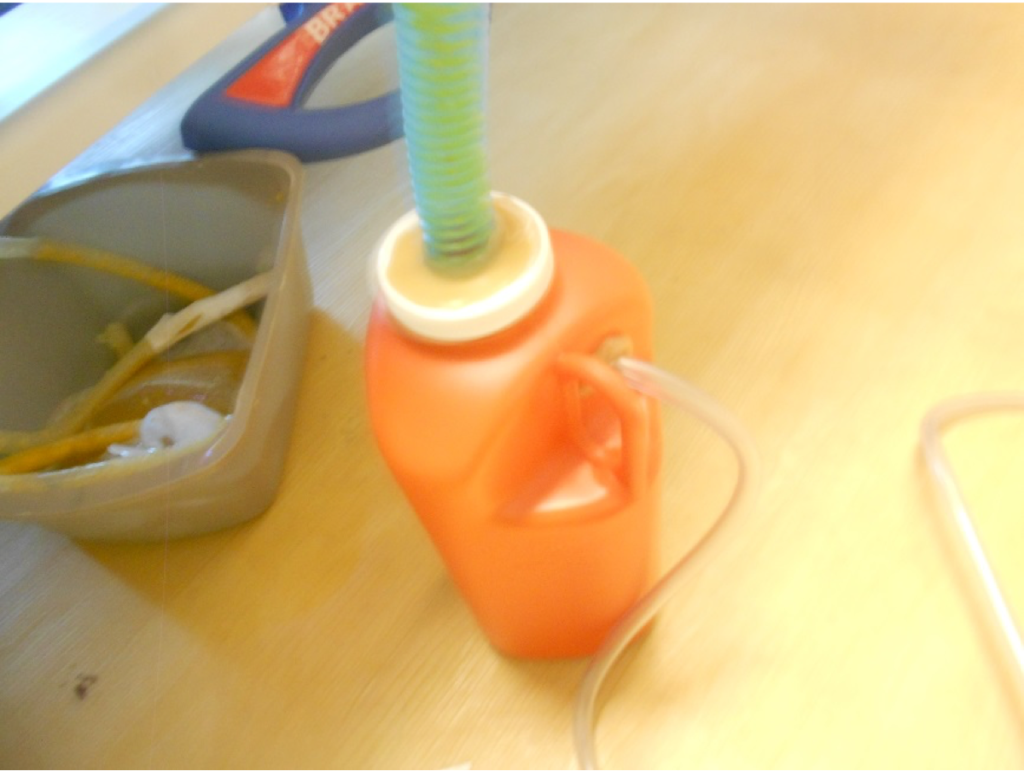 High-output Fistula and Ostomy Effluent Containment - Fistula Solution