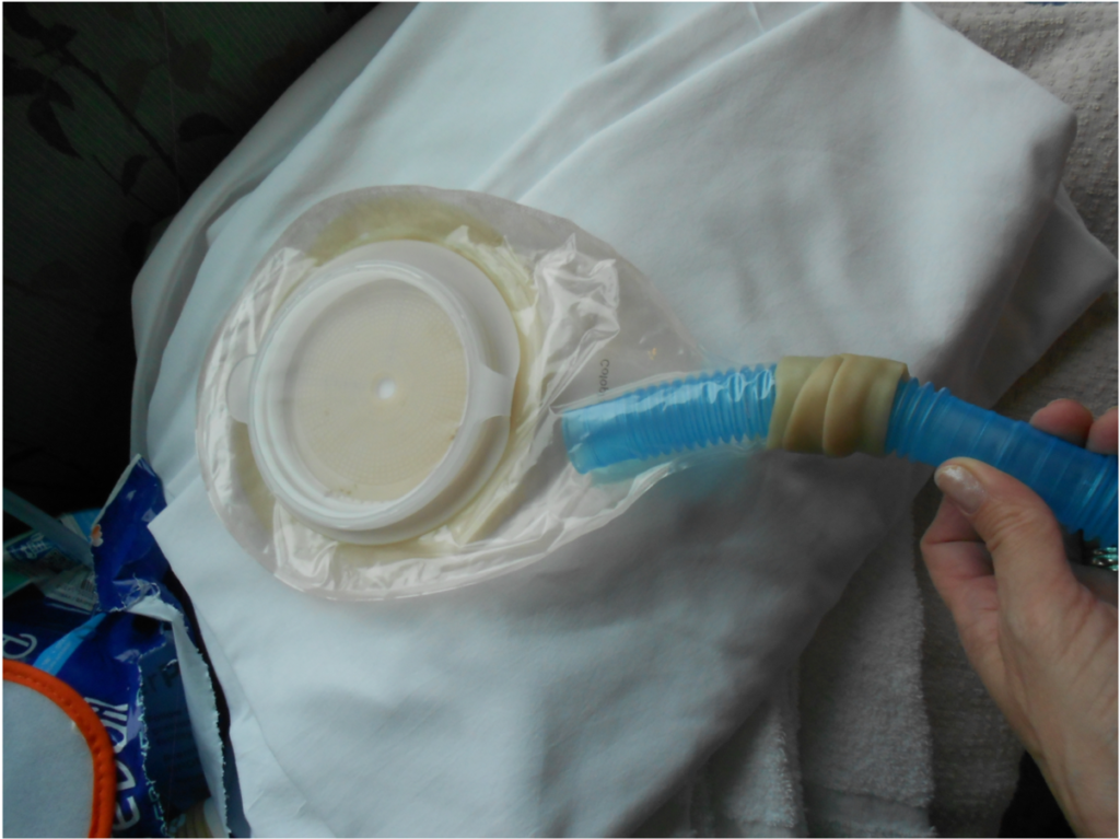 High-output Fistula and Ostomy Effluent Containment - Fistula Solution