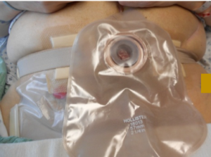 Belted Pouching with Fistula Solution Devices - Fistula Solution