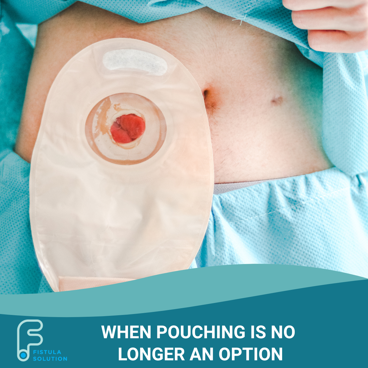 Complex Fistula Isolation: When Pouching Is No Longer an Option